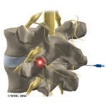 Medial Branch Block | Wake Spine & Pain Specialists